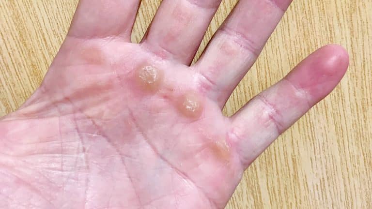 10 Tips On How To Prevent Calluses From Lifting