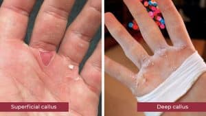 10 Tips On How To Prevent Calluses From Lifting